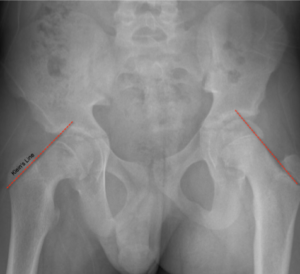 Slipped Capital Femoral Epiphysis — Pediatric EM Morsels